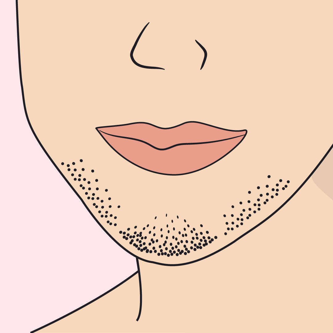 How To Manage Excessive Pcos Hair Growth Roseskinco